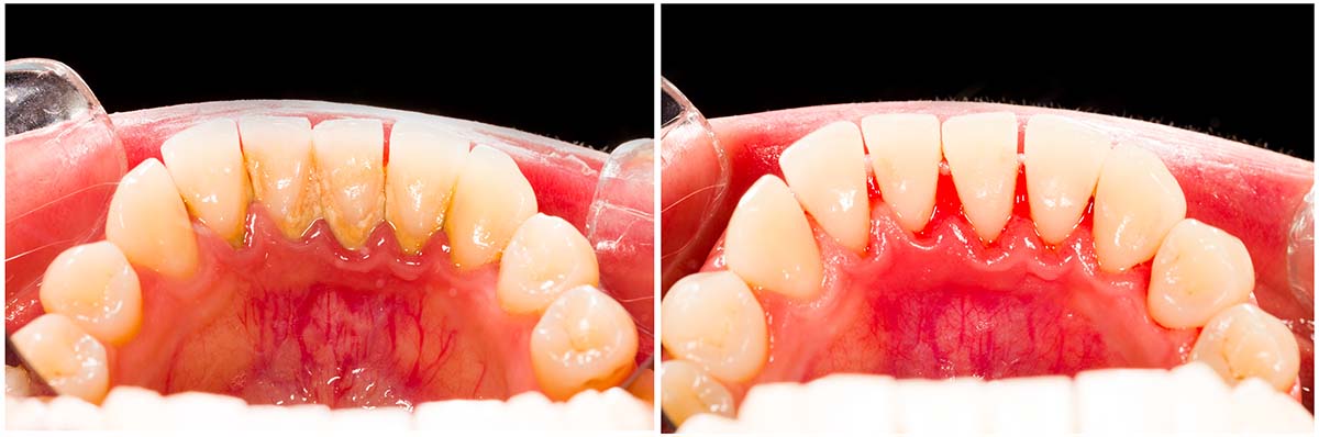 Complete guide to Tooth Plaque and Dental Tartar | Southland Dental Care