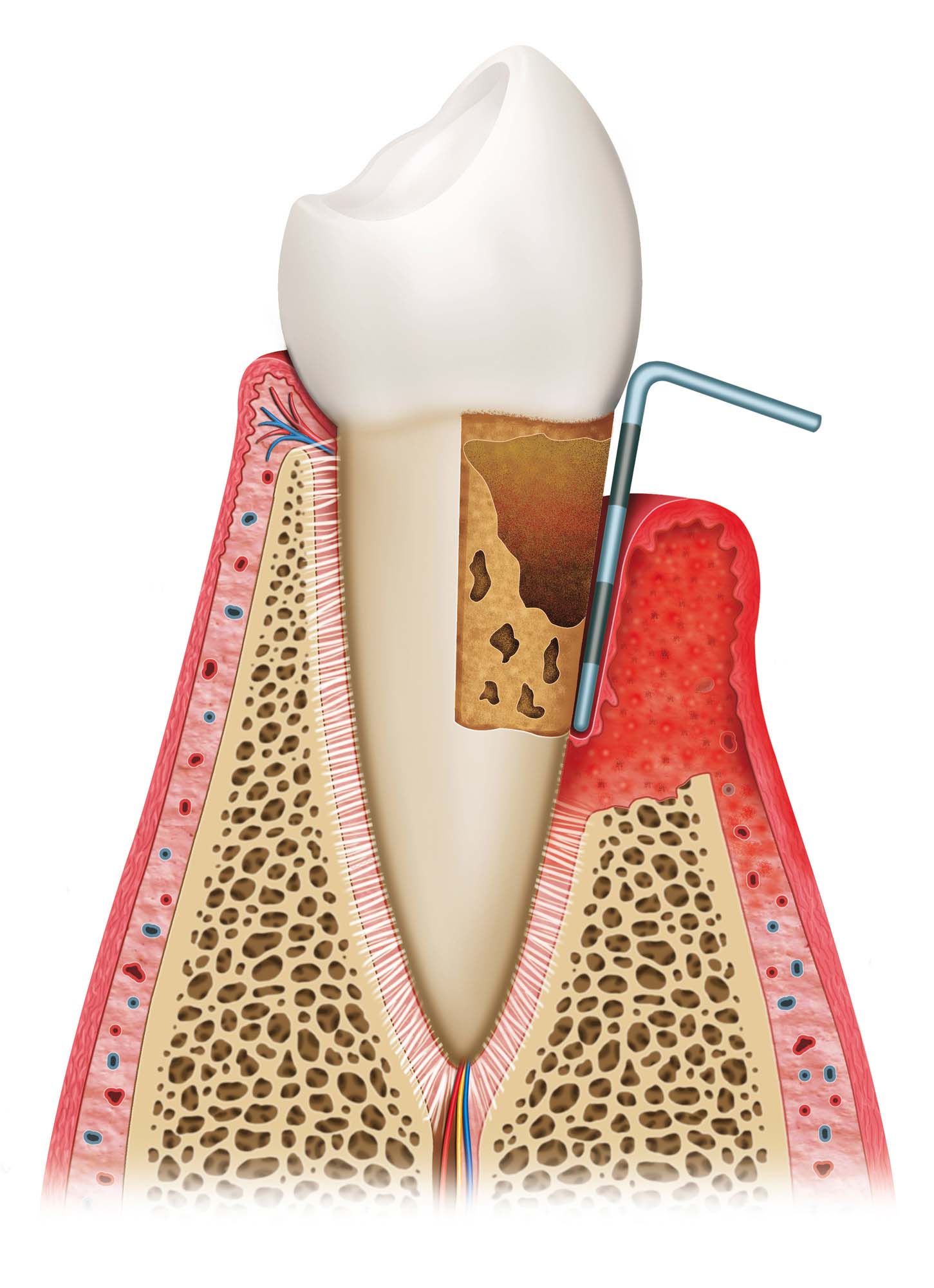 Importance of Treating Gum Disease Stages - Southland Dental Care