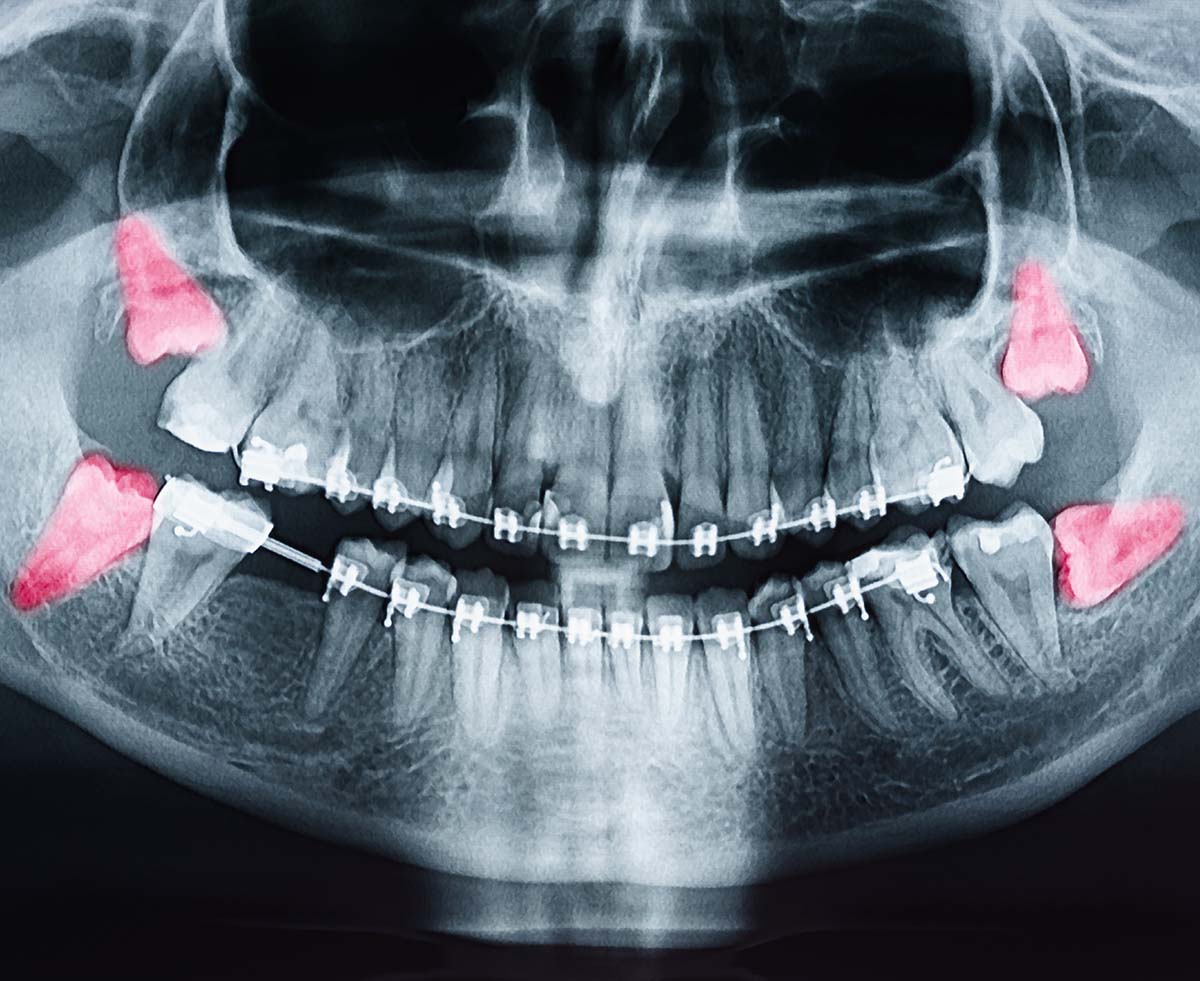 Wisdom Teeth Extraction Sherman Oaks, CA - Southland Dental Care