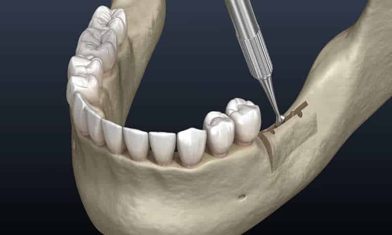 Ridge Augmentation Sherman Oaks, CA - Southland Dental Care